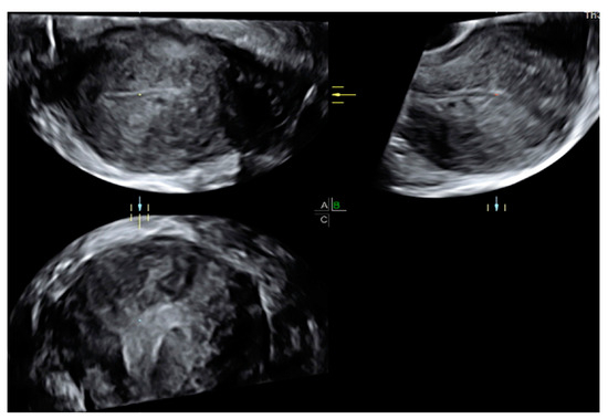 Adenomyosis: An Update Concerning Diagnosis, Treatment, and Fertility