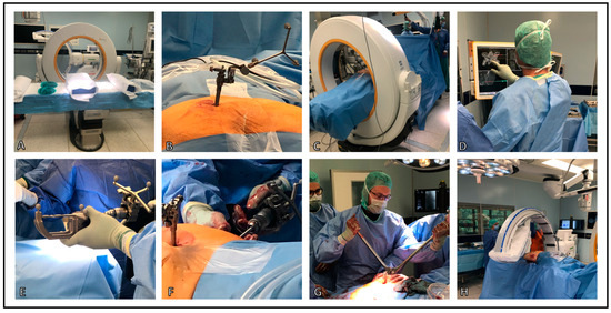 Feasibility and Safety of 3D-Navigated Trans-Sacral Bar Osteosynthesis ...