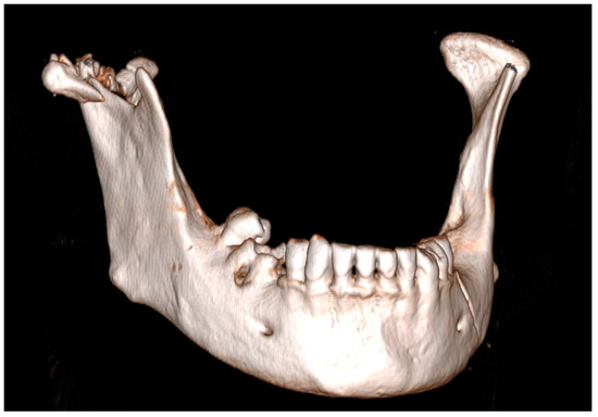 Personalized Temporomandibular Joint Total Alloplastic Replacement as a ...