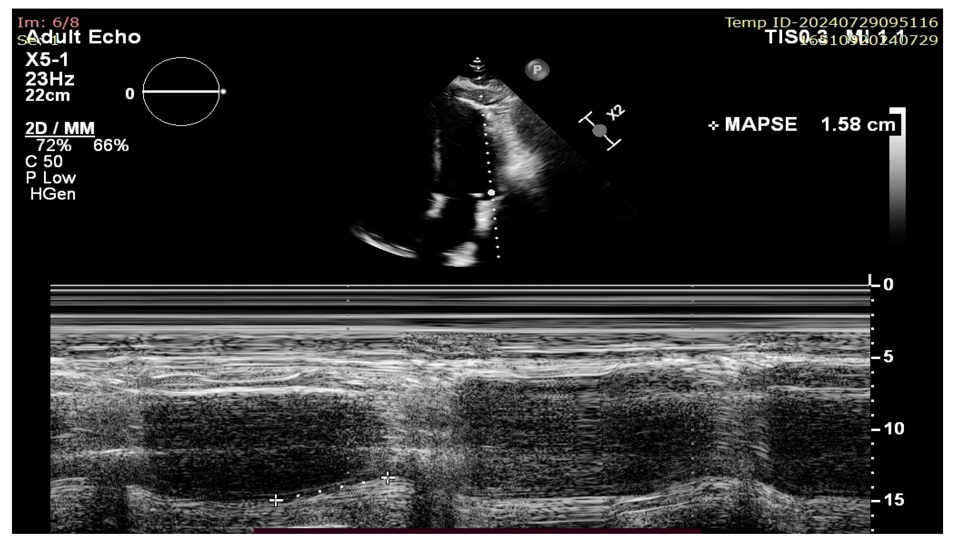 Mitral Annular Plane Systolic Excursion (MAPSE): A Review of a Simple ...