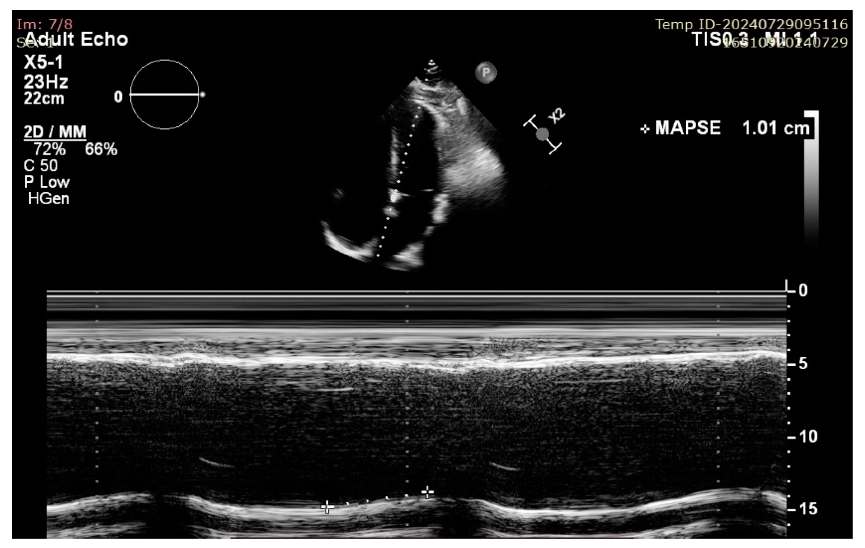 Mitral Annular Plane Systolic Excursion (MAPSE): A Review of a Simple ...