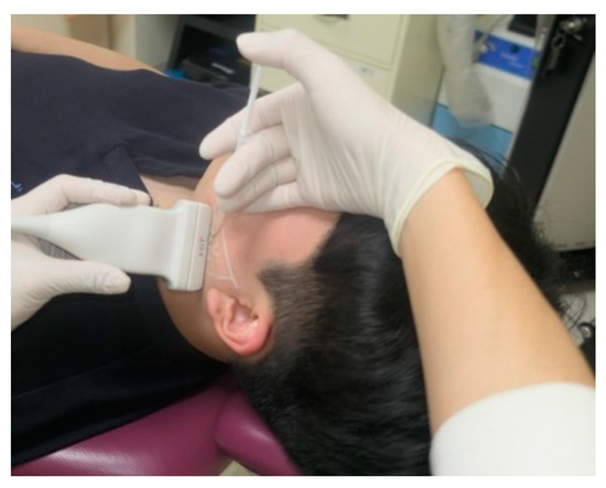 Prospective Analysis of the Effectiveness of Targeted Botulinum Toxin ...