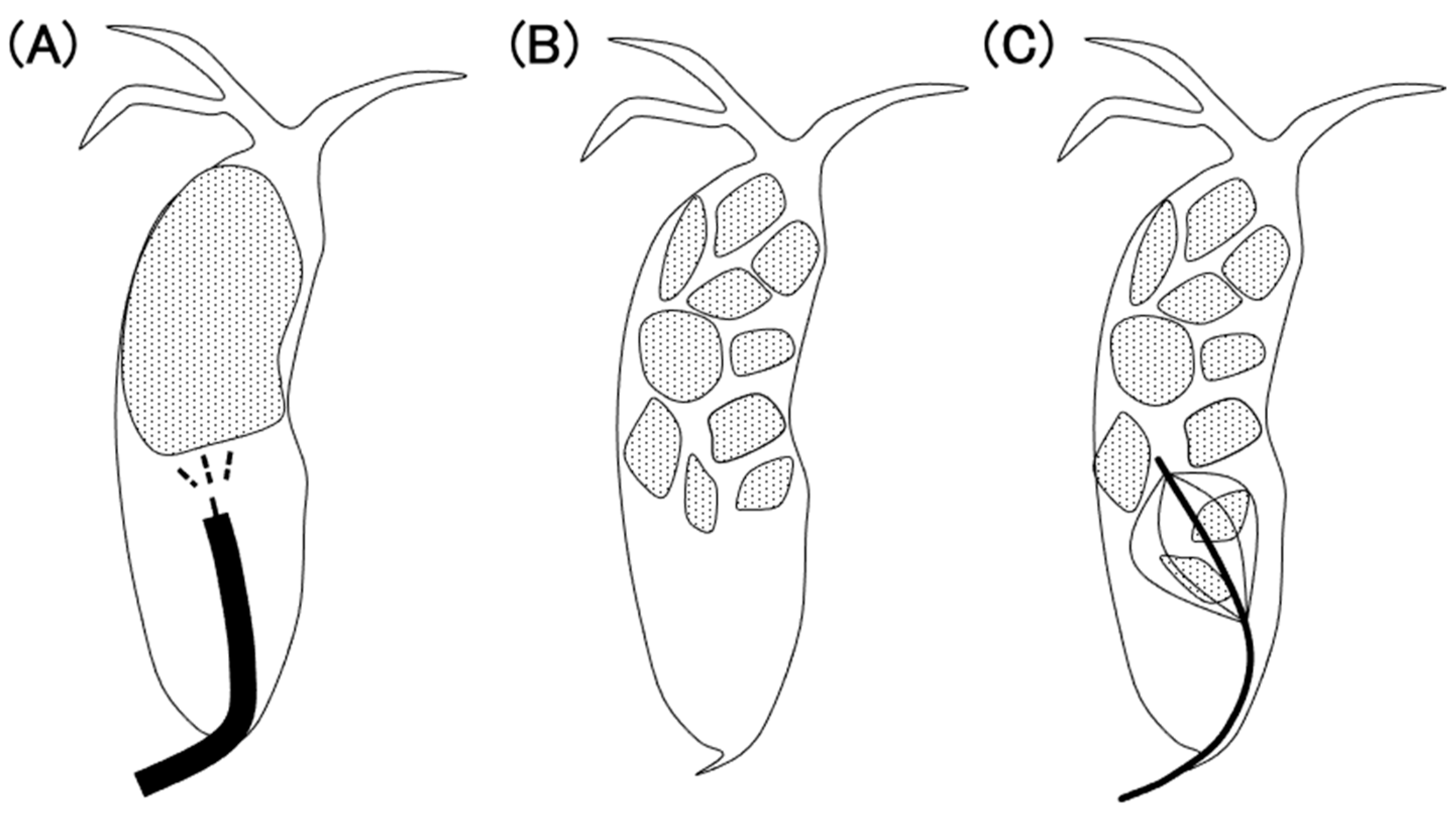 Comparative Study of Endoscopic Treatment for Intrahepatic and Common ...