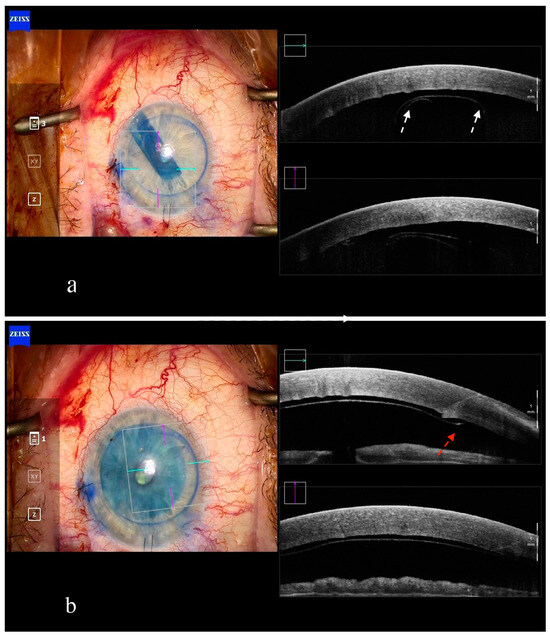 Emerging Applications of Intraoperative Optical Coherence Tomography in ...