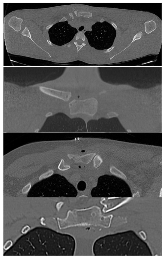 Management Options for Traumatic Posterior Sternoclavicular Joint ...