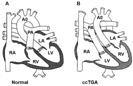 Pathogenesis and Surgical Treatment of Congenitally Corrected Transposition of the Great ...