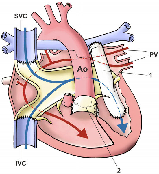 Pathogenesis and Surgical Treatment of Congenitally Corrected ...