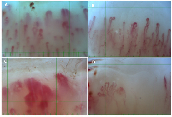 Nailfold Capillaroscopy Changes in Patients with Idiopathic ...