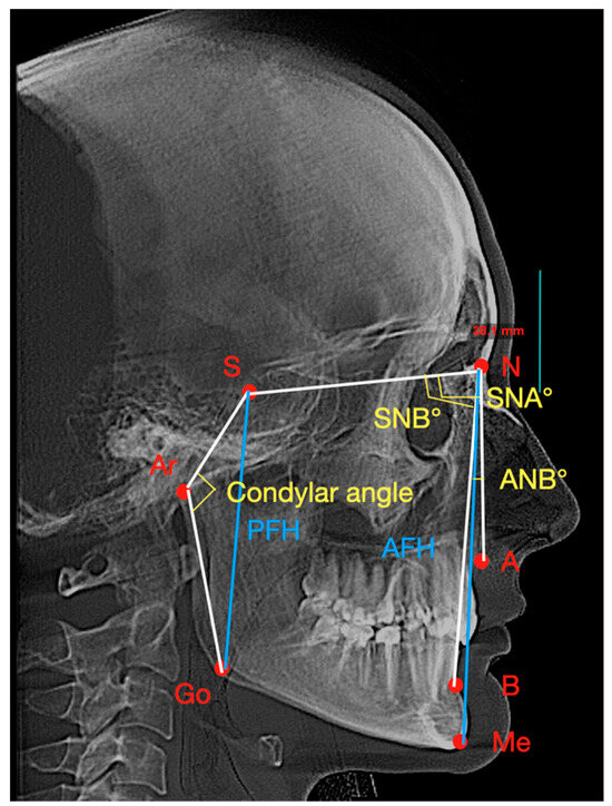 Condylar Remodeling and Skeletal Changes Following Occlusal Splint and ...