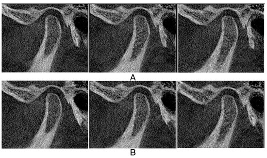 Condylar Remodeling and Skeletal Changes Following Occlusal Splint and ...