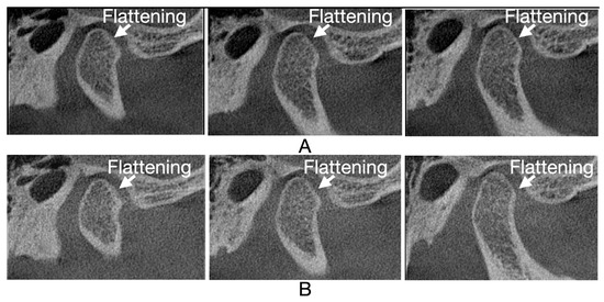 Condylar Remodeling and Skeletal Changes Following Occlusal Splint and ...