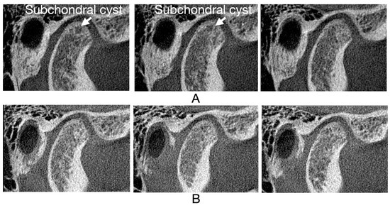 Condylar Remodeling and Skeletal Changes Following Occlusal Splint and ...