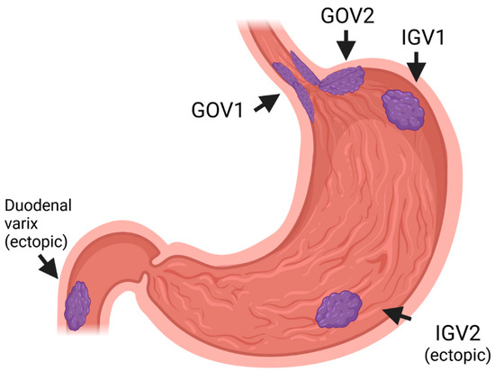 Transjugular Intrahepatic Portosystemic Shunt (TIPS) for Treatment of Bleeding from Cardiofundal ...