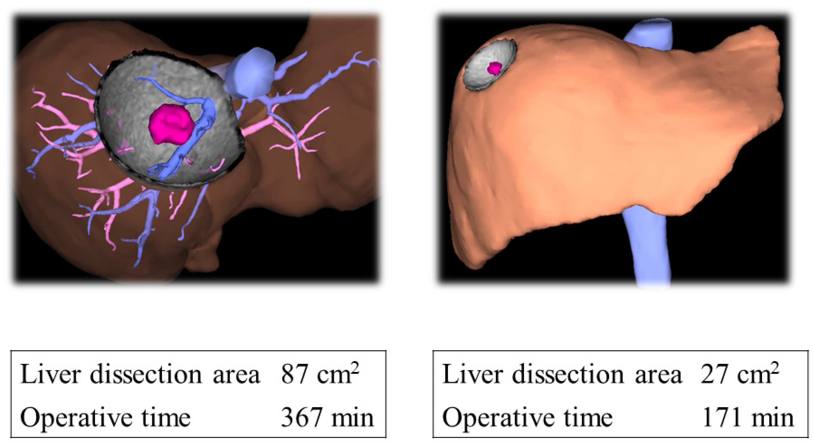 The Liver Transection Area Is a Novel Predictor for Surgical Difficulty in Laparoscopic Liver ...
