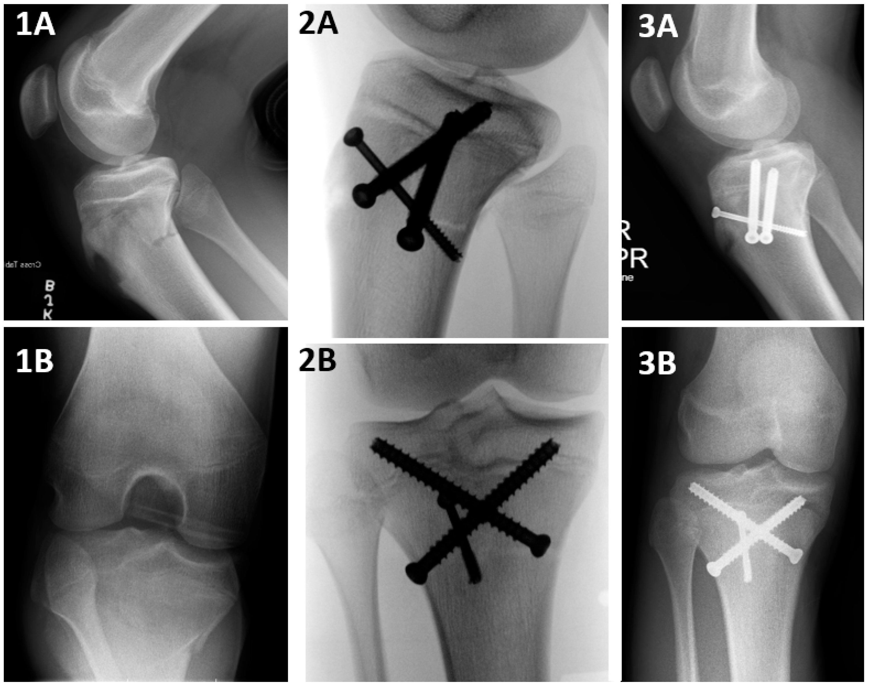Type 4 Tibial Tuberosity Avulsion Fractures: Surgical Treatment Early ...