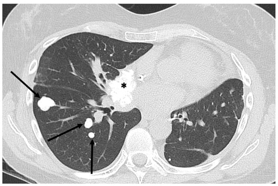 Imaging of Osteosarcoma: Presenting Findings, Metastatic Patterns, and ...