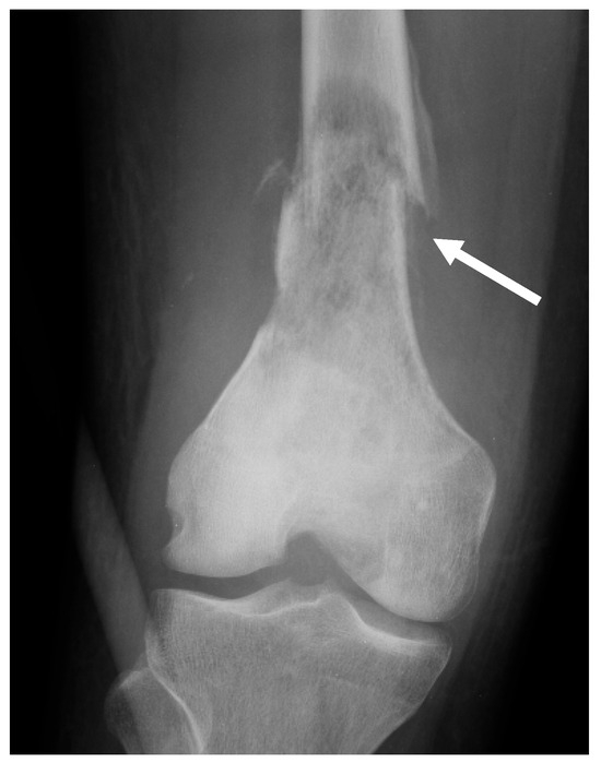 Imaging of Osteosarcoma: Presenting Findings, Metastatic Patterns, and ...