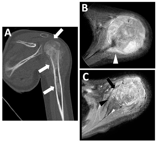 Imaging of Osteosarcoma: Presenting Findings, Metastatic Patterns, and ...