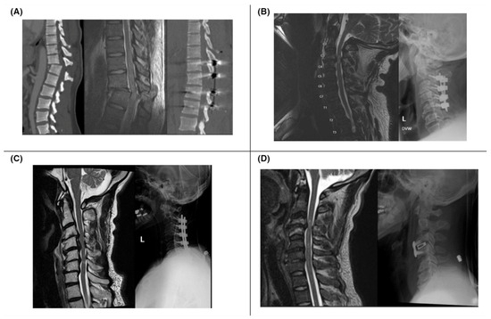 Clinical Assessment and Management of Acute Spinal Cord Injury