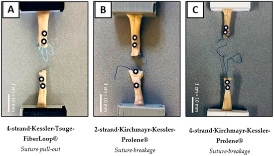 Biomechanical Comparison of Three Modified Kessler Techniques for ...