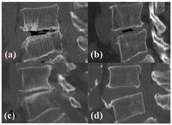 Impact of the Disc Vacuum Phenomenon on Surgical Outcomes in Lumbar ...