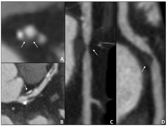 Coronary Artery Disease, Family History, and Screening Perspectives: An ...