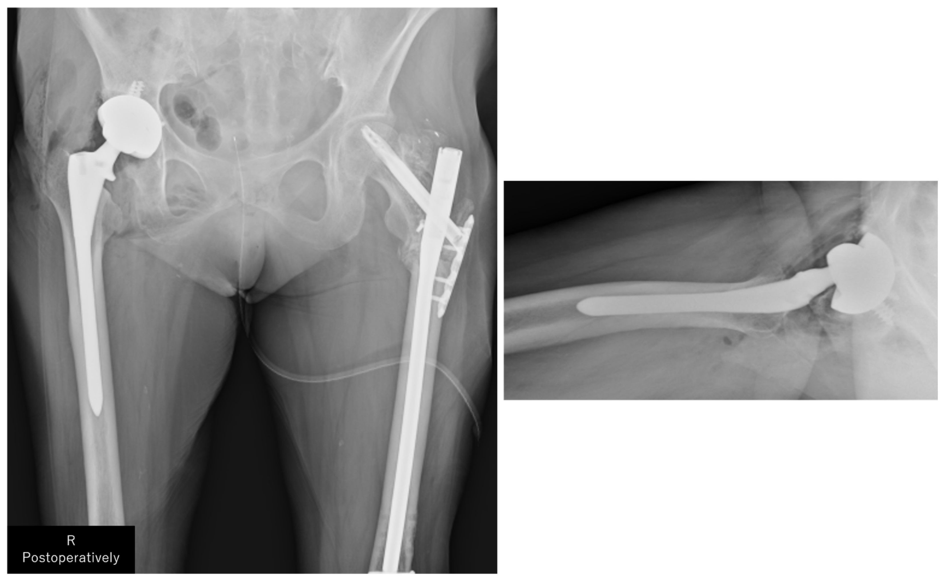 Total Hip Arthroplasty in Hip Osteoarthritis with Subtrochanteric ...