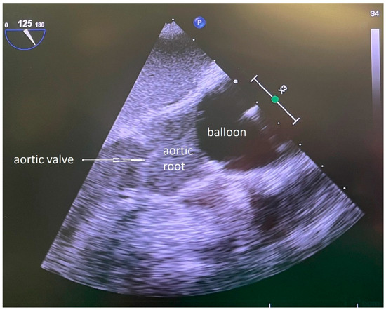 Endo-Aortic Clamping with the IntraClude® Device in Minimally Invasive ...