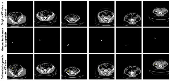 Fully Automated Detection of the Appendix Using U-Net Deep Learning ...