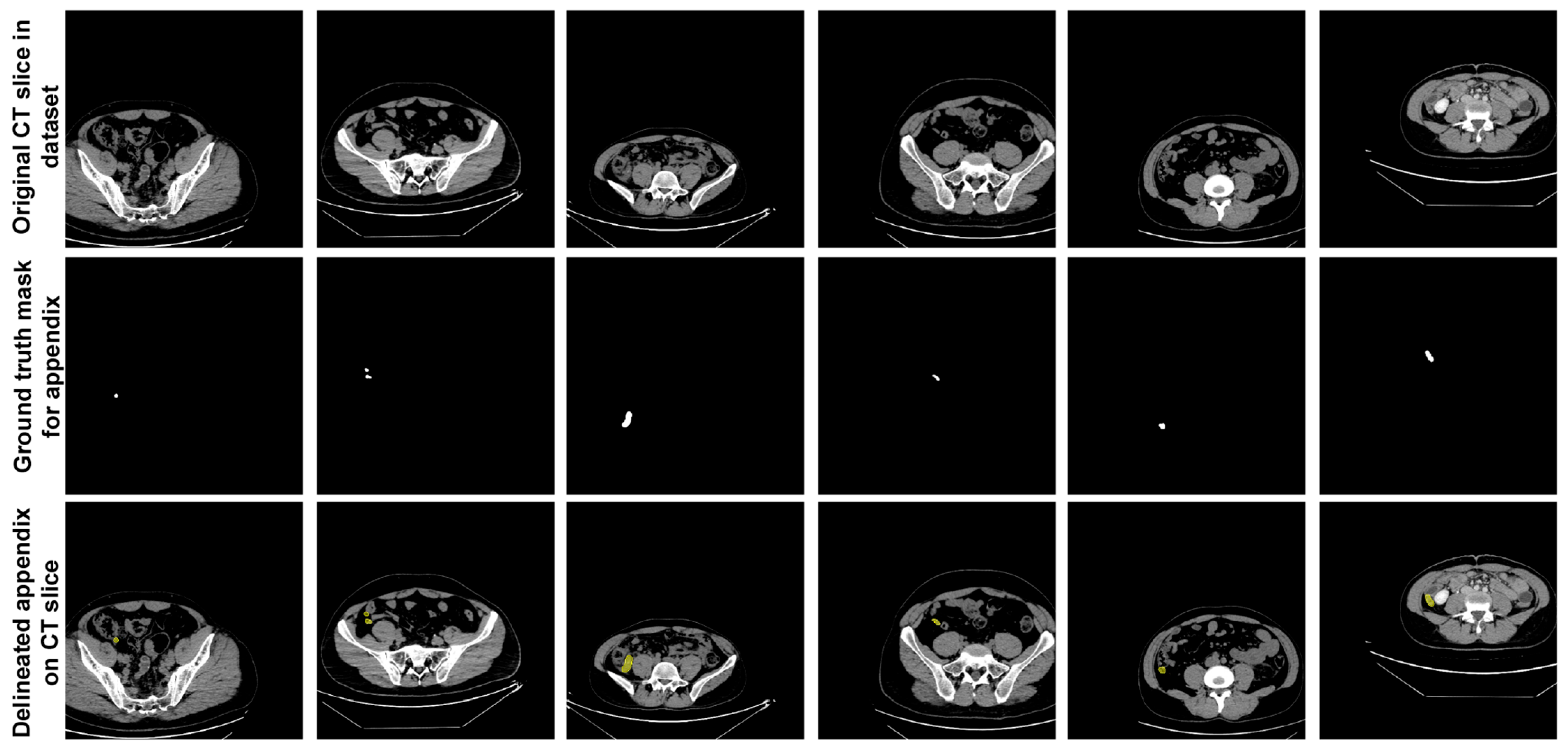 Fully Automated Detection of the Appendix Using U-Net Deep Learning Architecture in CT Scans