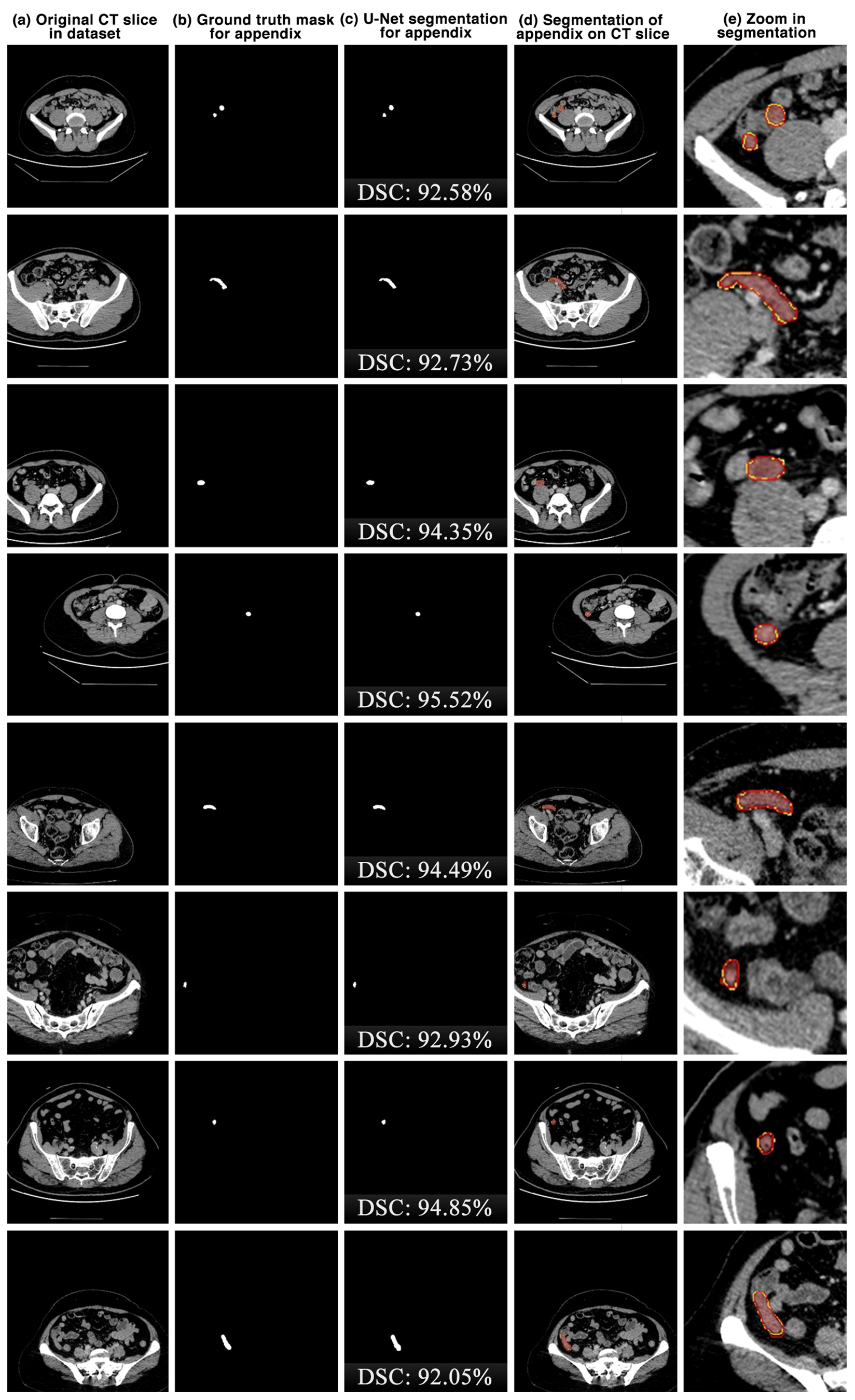 Fully Automated Detection of the Appendix Using U-Net Deep Learning Architecture in CT Scans