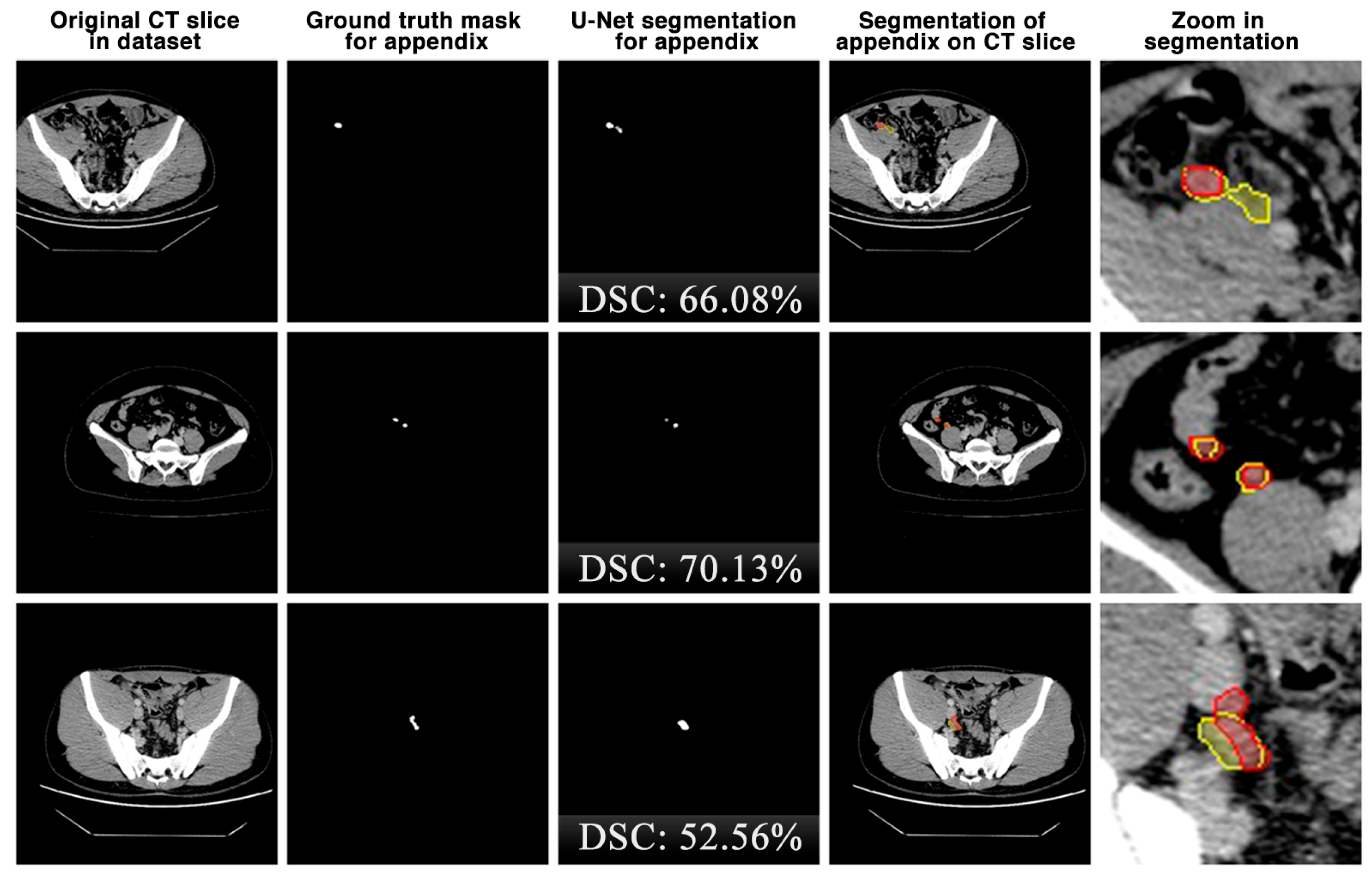 Fully Automated Detection of the Appendix Using U-Net Deep Learning Architecture in CT Scans
