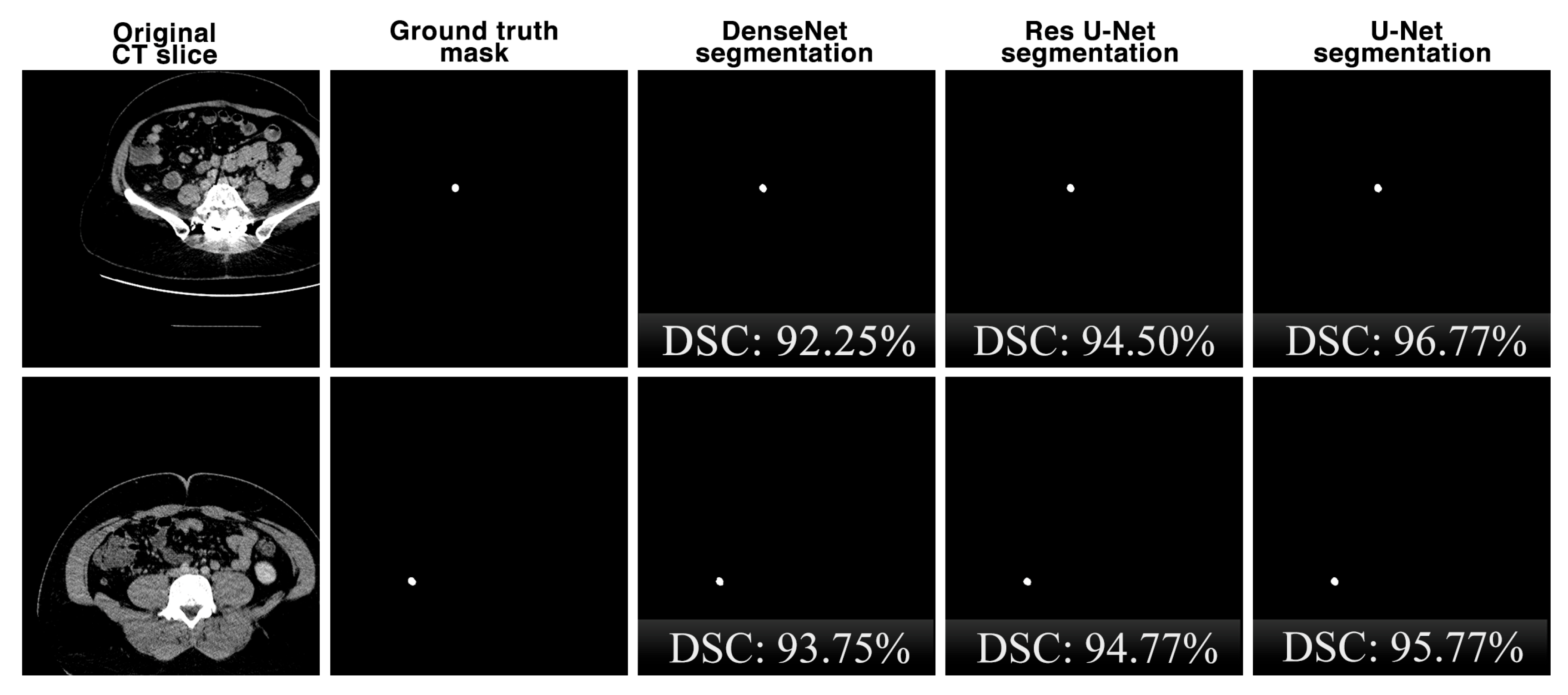Fully Automated Detection of the Appendix Using U-Net Deep Learning Architecture in CT Scans