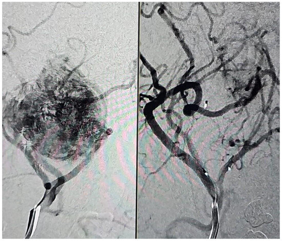 Preoperative Embolization of Glomus Tumors: Role, Effectiveness, and ...