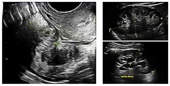 Concordance between Preoperative #ENZIANi Score and Postoperative # ...