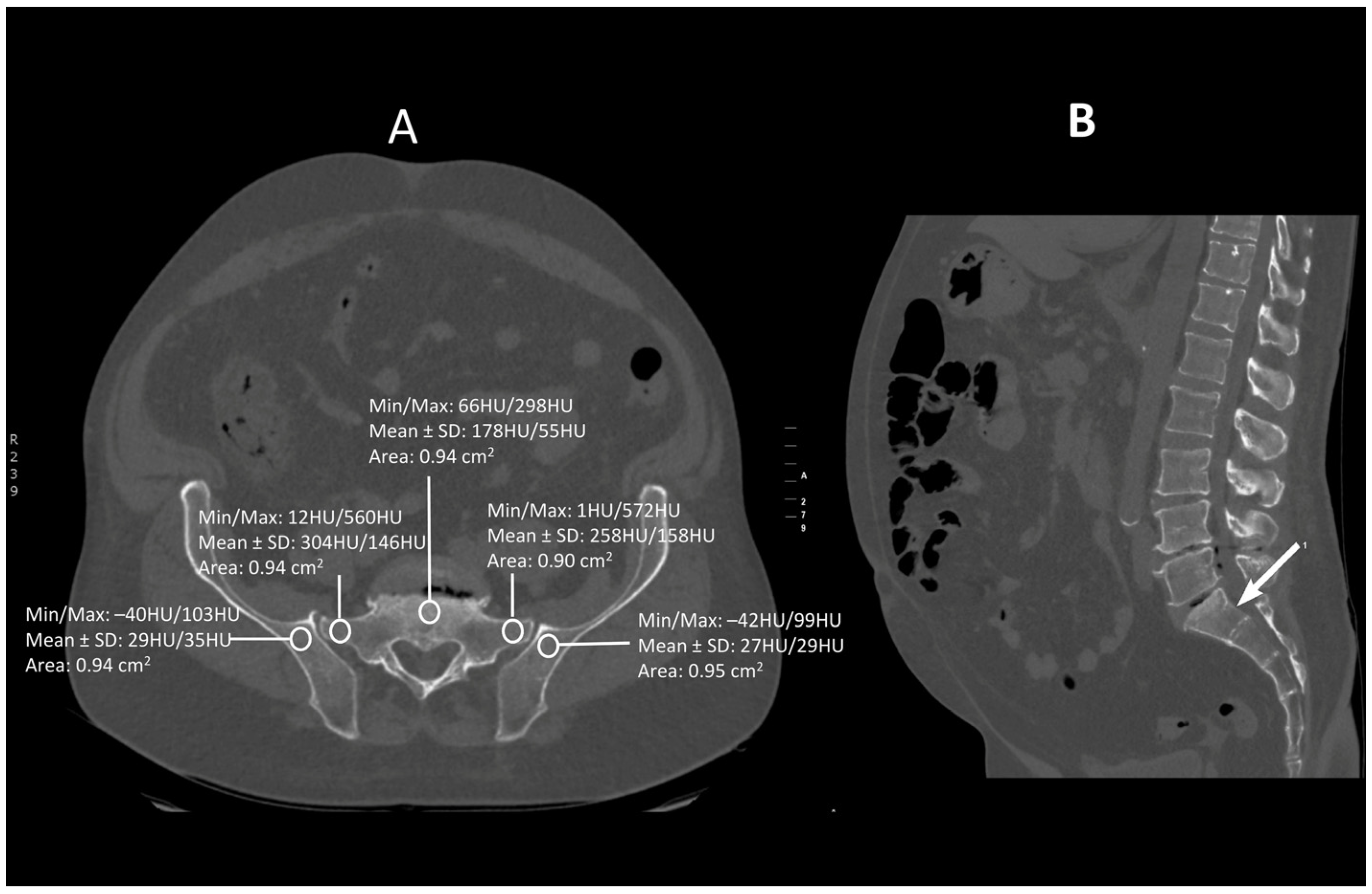 CT-Based Evaluation of Volumetric Posterior Pelvic Bone Density with ...