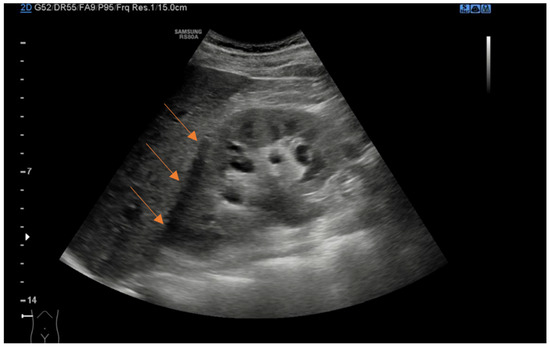 Clinical Significance of Perinephric Fluid Collection in Patients with ...