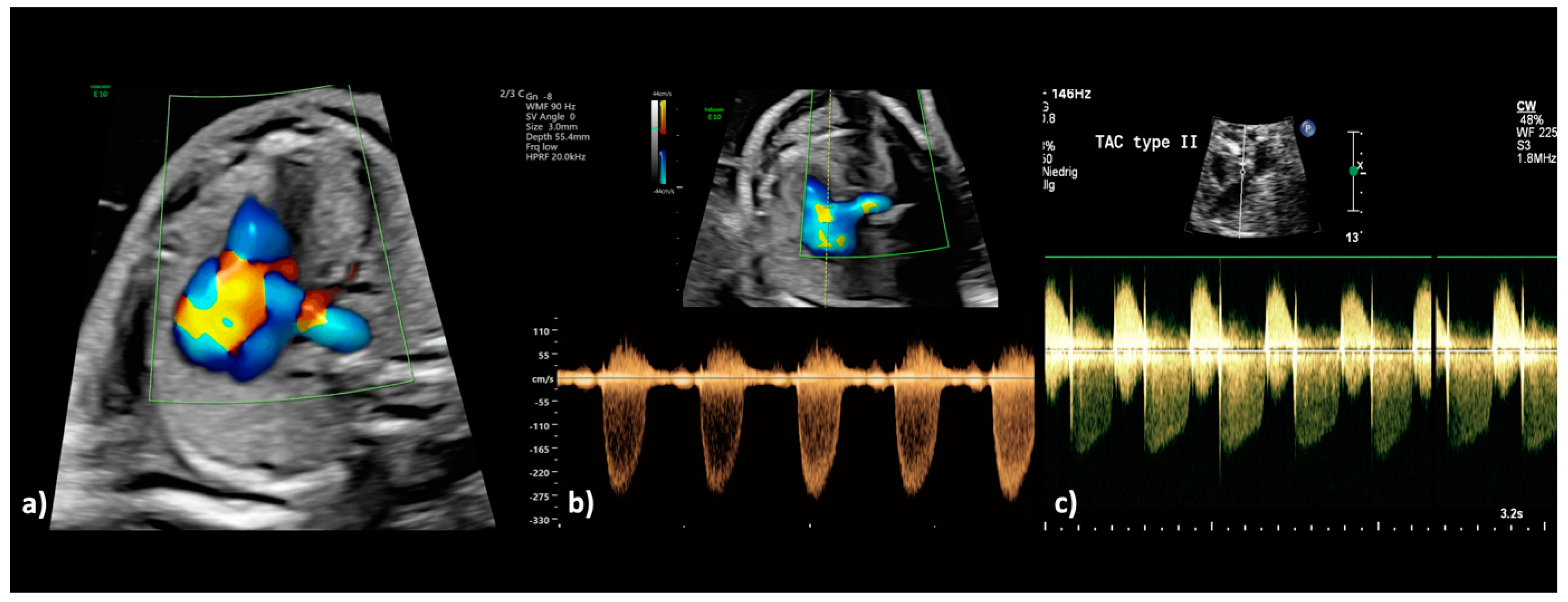 Diagnosis, Management and Outcome of Truncus Arteriosus Communis ...