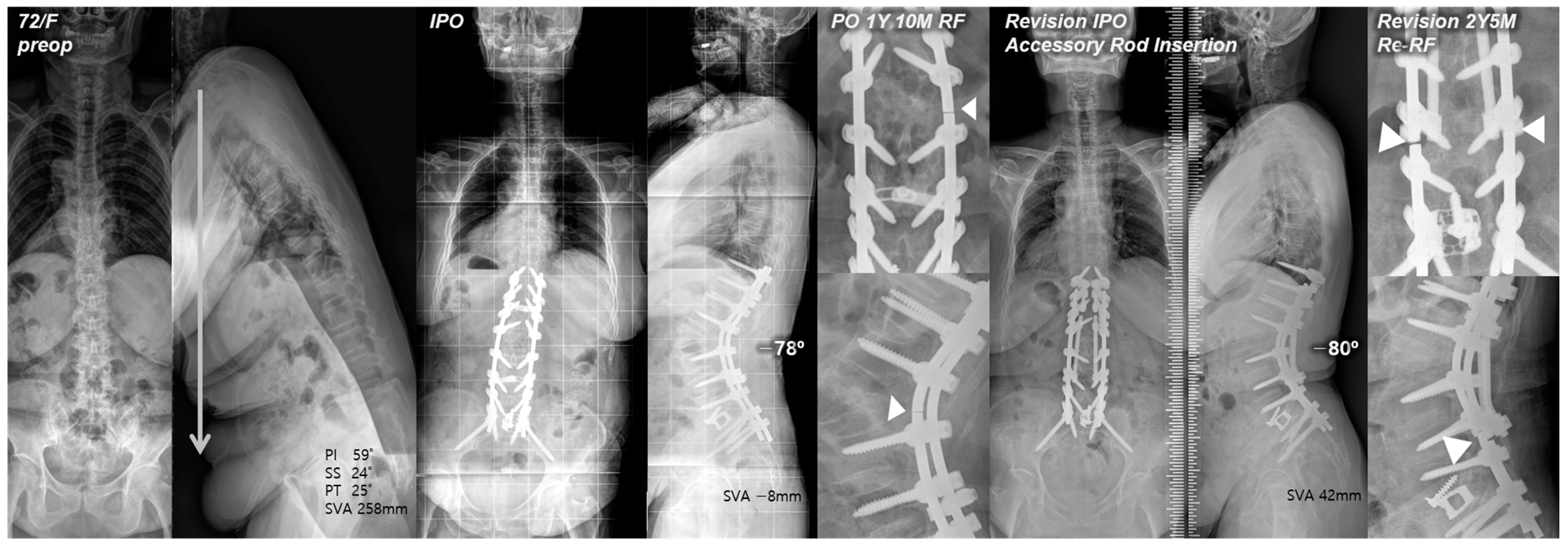 Comparison of Revision Techniques for Rod Fracture after Adult Spinal ...