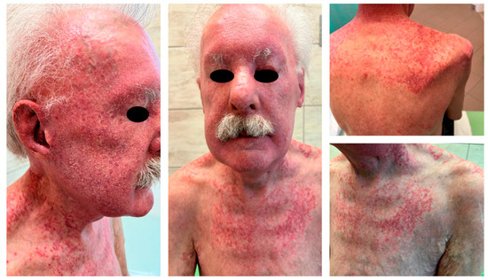 Treatment of Calcinosis in Dermatomyositis—Case Report and Review