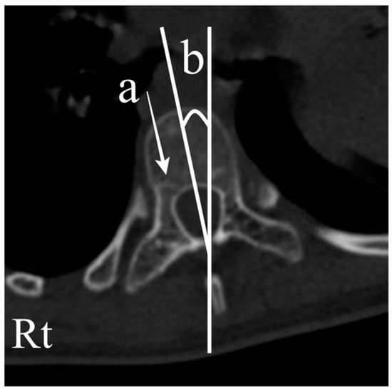 Vertebral Body Morphology in Neuromuscular Scoliosis with Spastic ...