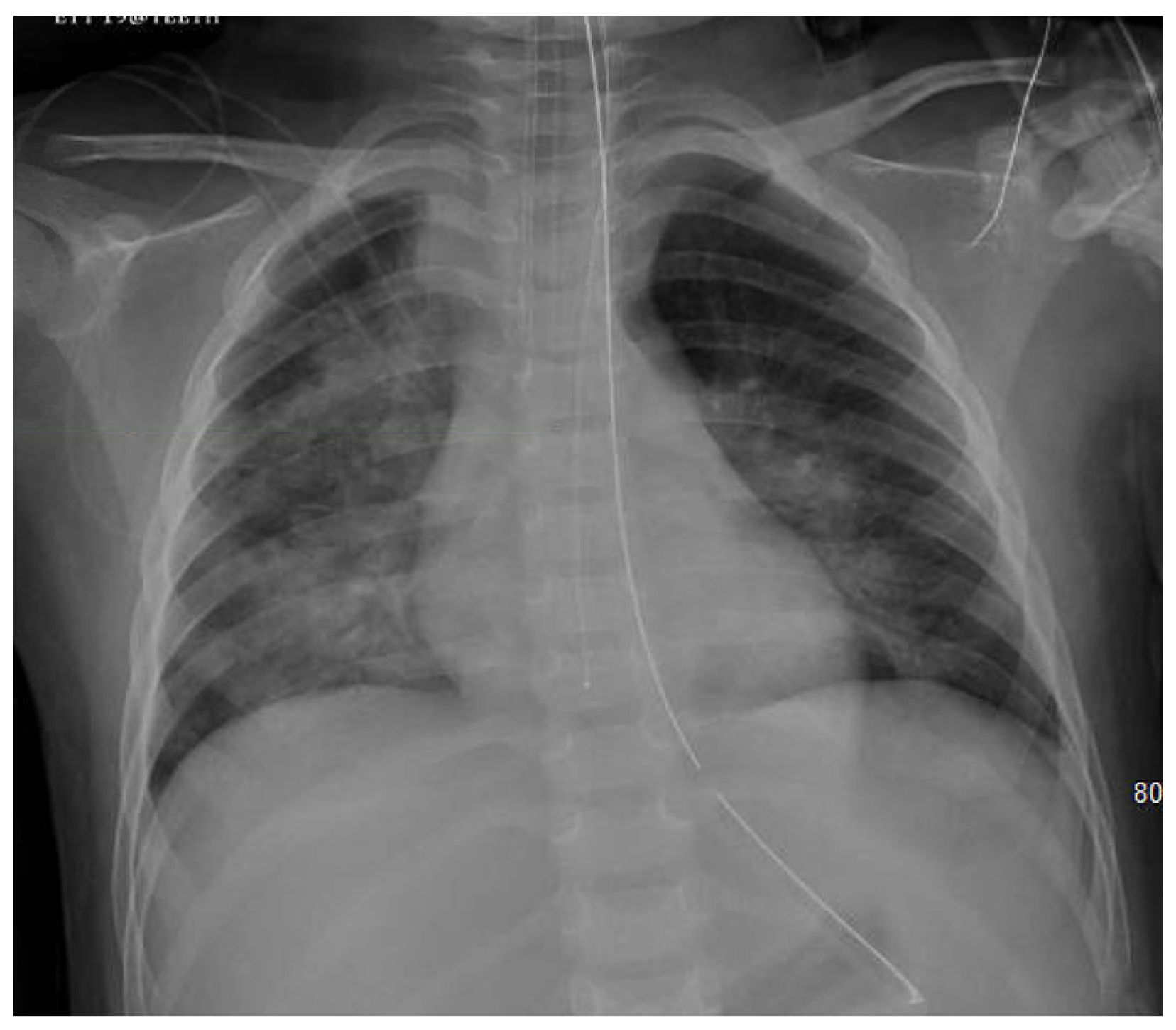 Fluid Overload in Children Following Hematopoietic Cell Transplant: A ...