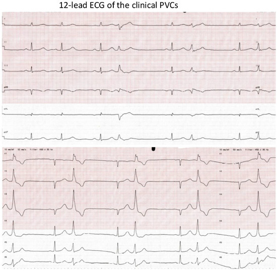 3D Map Combined with Transthoracic Echocardiography for Ablation of ...