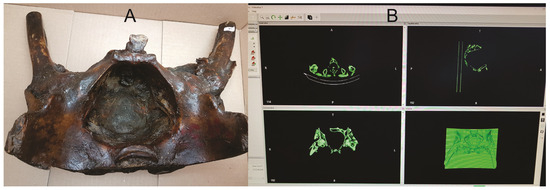 A 3D-Printed, High-Fidelity Pelvis Training Model: Cookbook ...