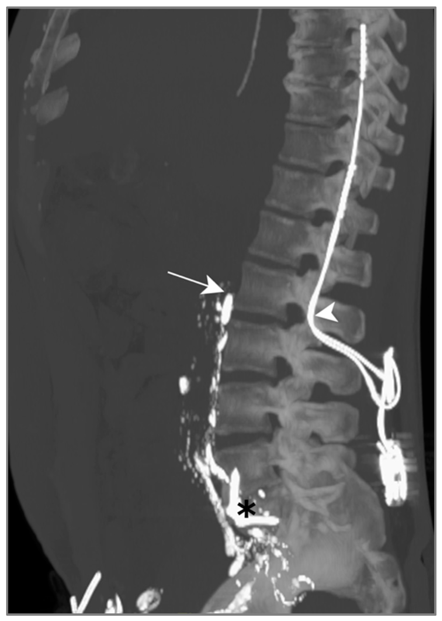 Ultrasound-Guided Intranodal Lipiodol Lymphangiography for the ...