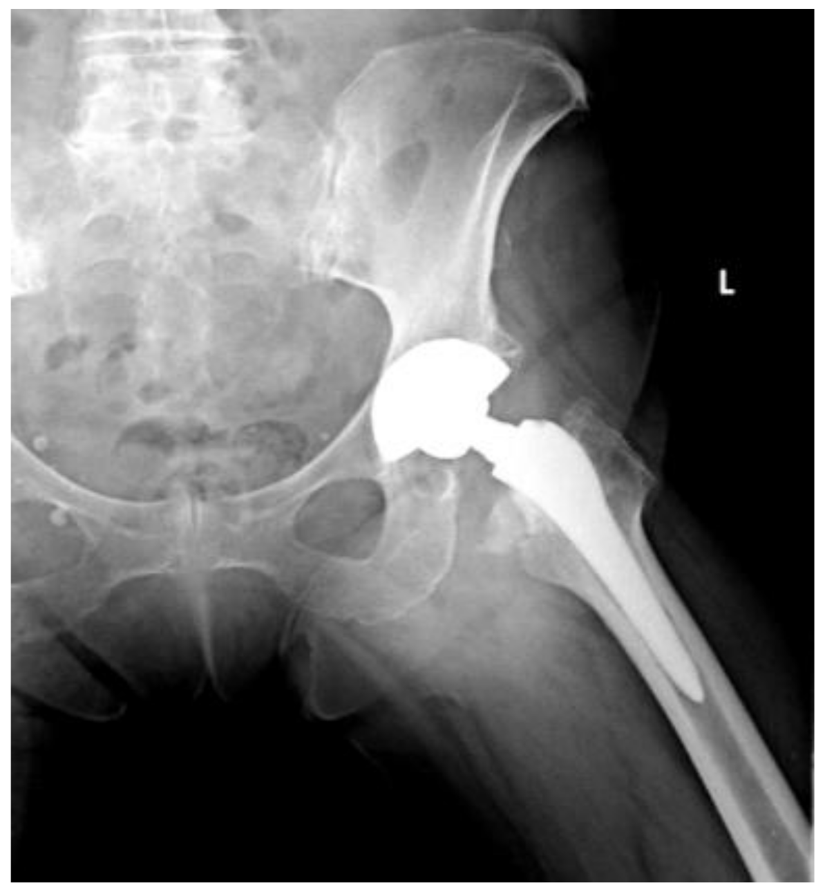 Influence of Femoral Stem Geometry on Total Hip Replacement: A ...