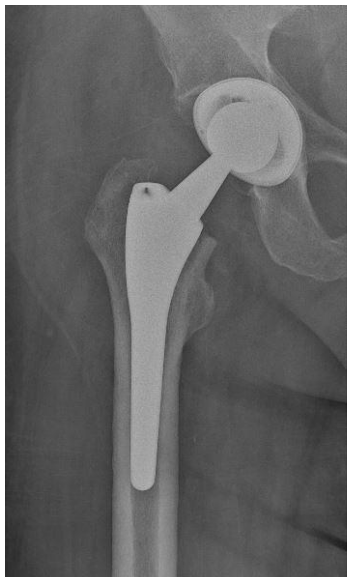 Influence of Femoral Stem Geometry on Total Hip Replacement: A ...