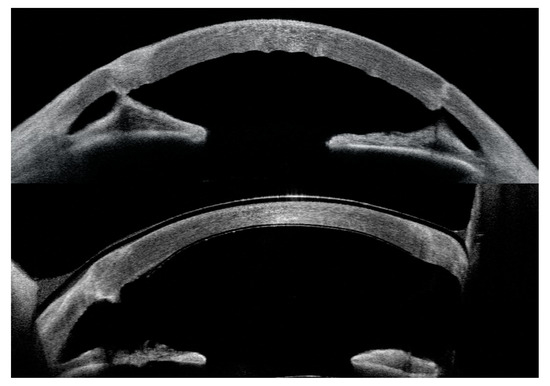 Corneal Artificial Endothelial Layer (EndoArt): Literature Review and ...