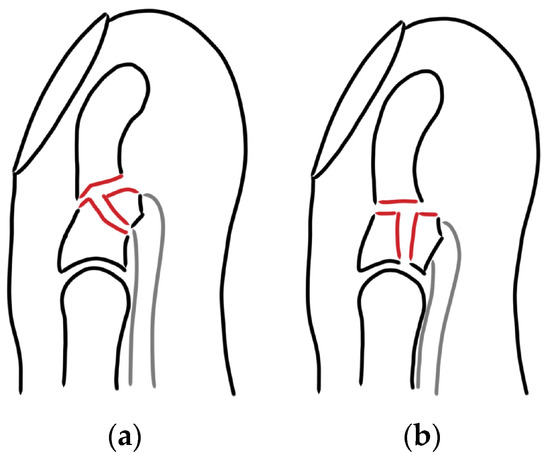 Characteristics and Therapy of Jersey Finger Type V Injuries at a ...