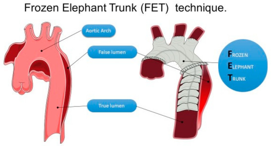 The Frozen Elephant Trunk Procedure—8 Years of Experience from Poland